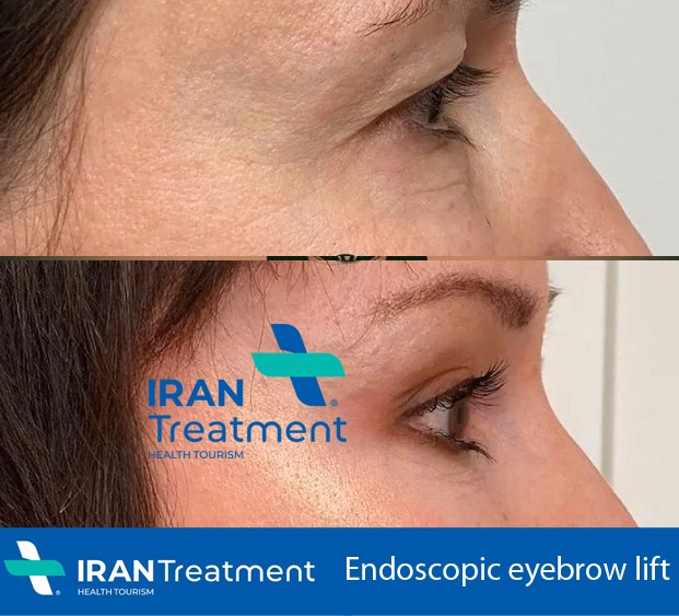 Temporal lift - Eyebrow lift in Istanbul - Endotine - Treatment in Istanbul