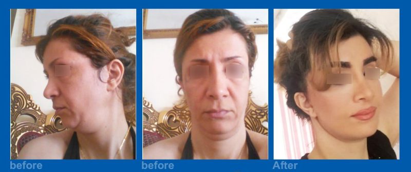 Travel plan for facelift surgery in Istanbul - 40 tips - Treatment in ...