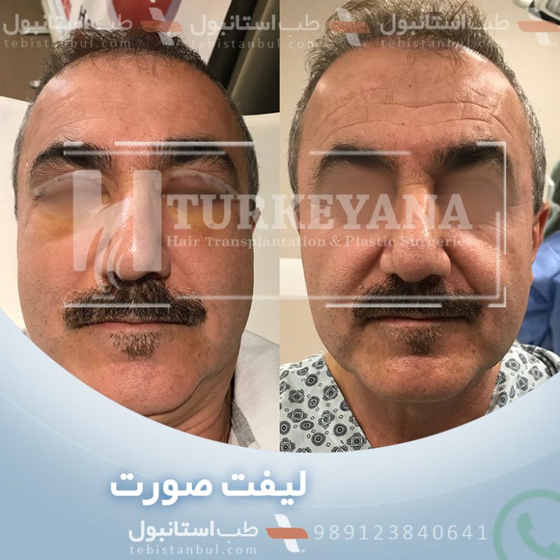 Travel plan for facelift surgery in Istanbul - 40 tips - Treatment in ...