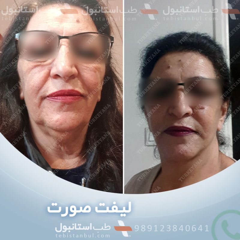 Travel plan for facelift surgery in Istanbul - 40 tips - Treatment in ...