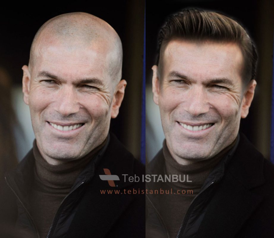 Zidane before and after Hair Transplant in Istanbul - Treatment in Istanbul