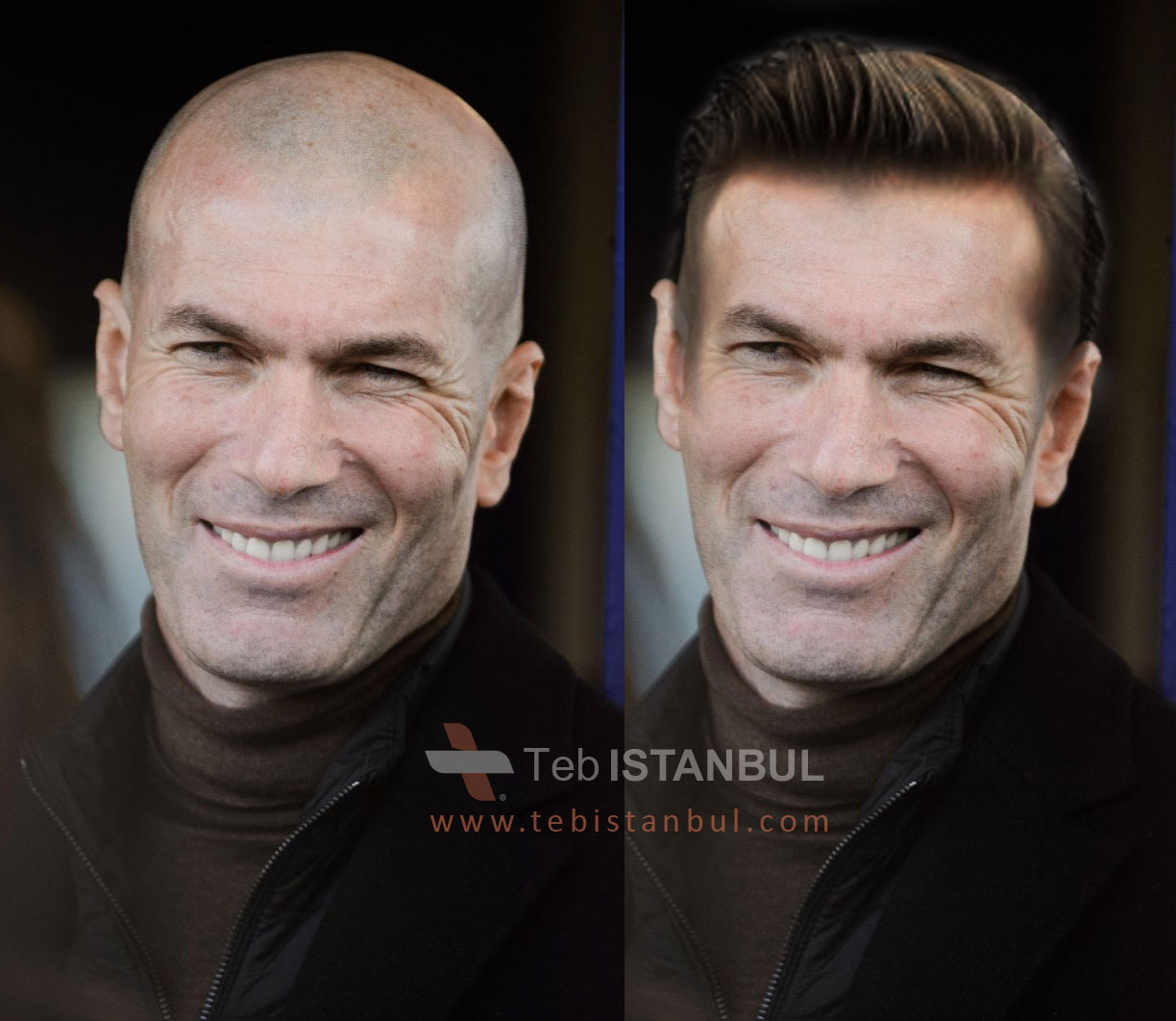 Zidane before and after Hair Transplant in Istanbul - Treatment in Istanbul