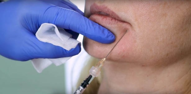 Gel injection in Istanbul - types of gel, uses and complications 2023 ...