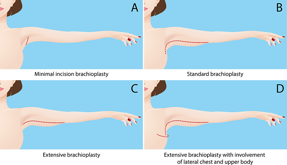 Arm Lift in Istanbul (Brachioplasty) Recovery & Cost 2024 - Treatment ...